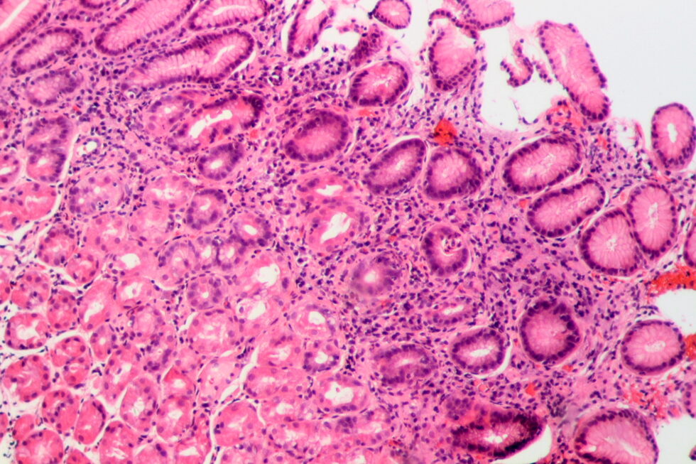 Human immune responses to H. pylori HLA Class II epitopes identified by ...